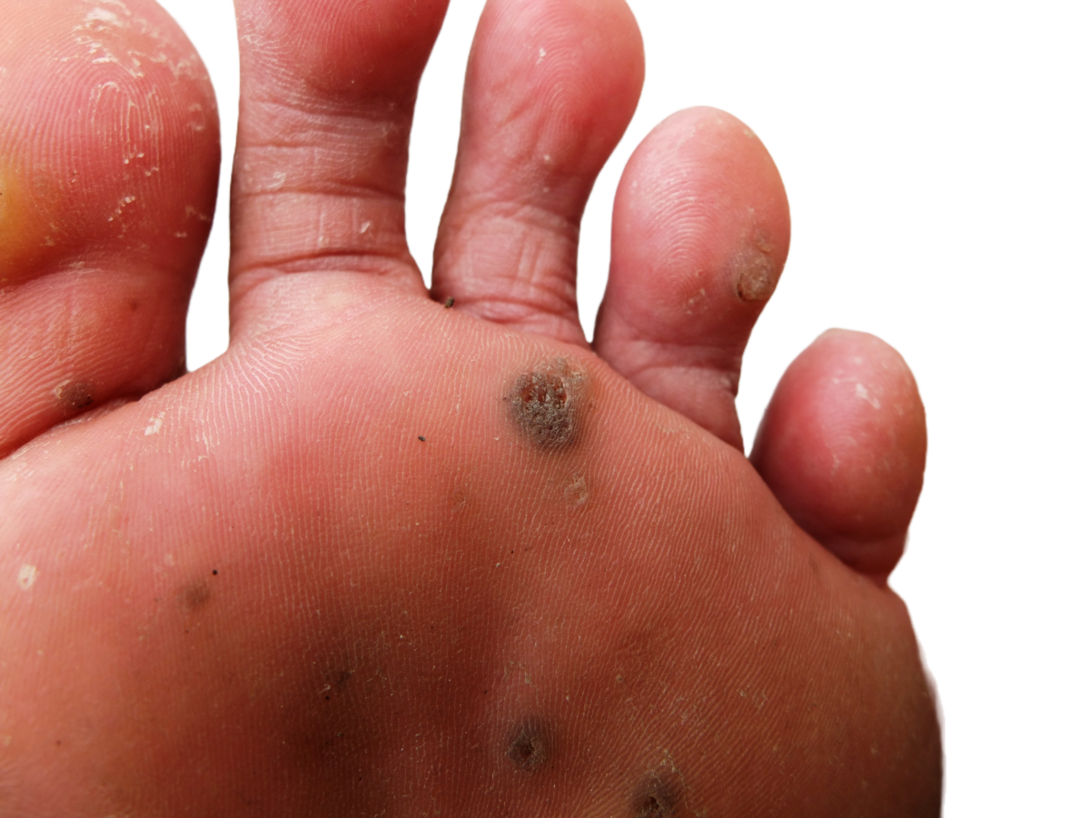 Stepping Out with Confidence: Verruca Treatment and Prevention ...